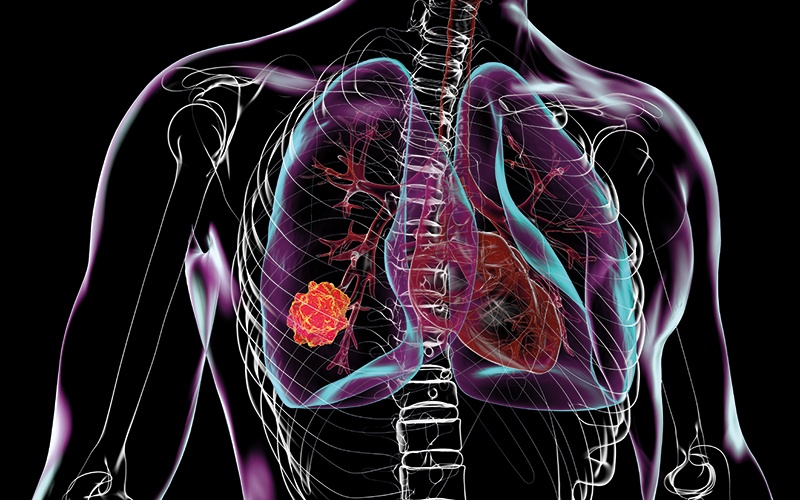 “Super survivor” cancer study launches in the UK | Biomedical Scientist