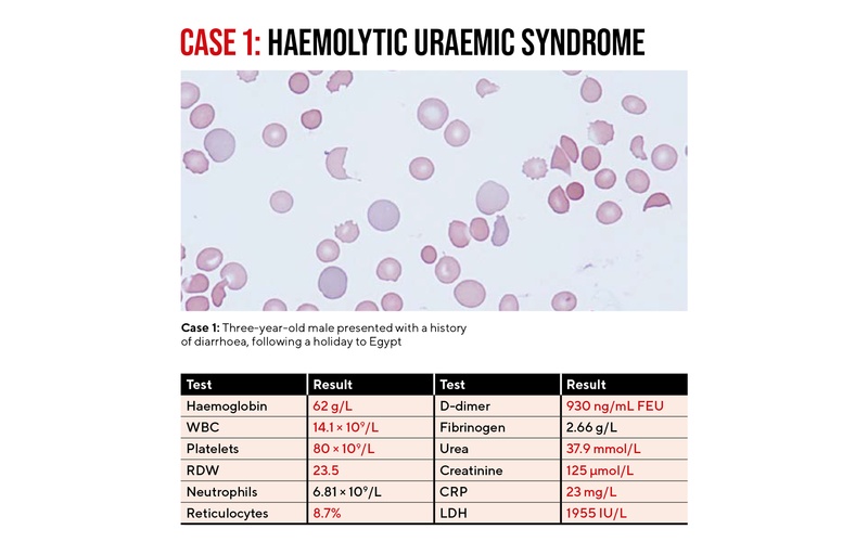Bitesize morphology: schistocyte or fragment? | Biomedical Scientist