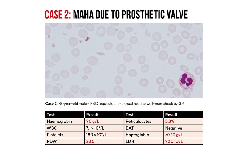 Bitesize morphology: schistocyte or fragment? | Biomedical Scientist