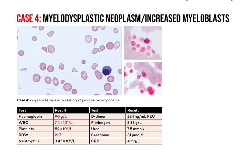 Bitesize morphology: schistocyte or fragment? | Biomedical Scientist