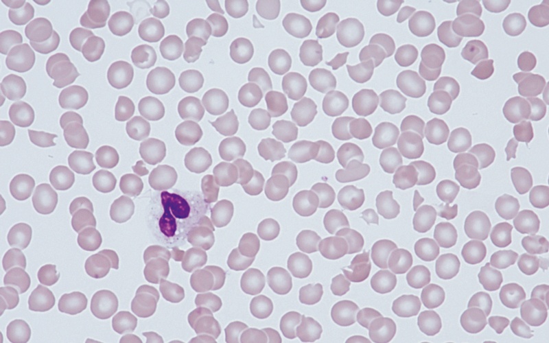 Bitesize morphology: schistocyte or fragment? | Biomedical Scientist
